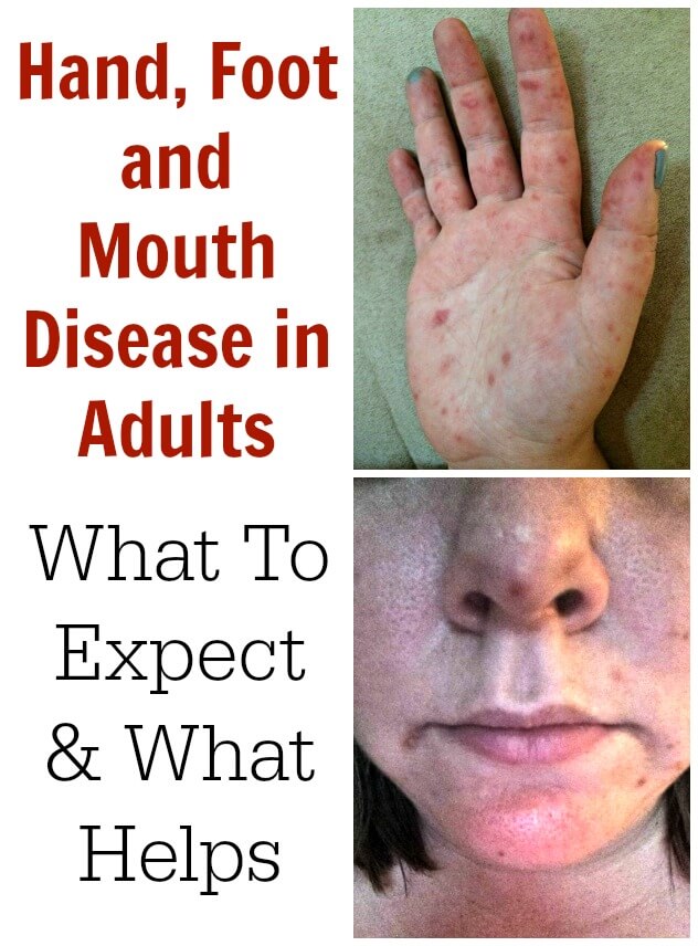 Hand Foot And Mouth Disease In Adults Antibiotics At Raymond Terrell Blog